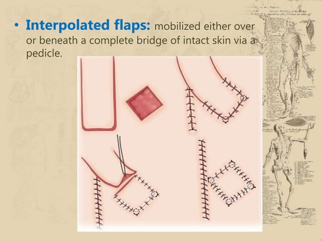 Local and regional flaps in head and neck reconstruction | PPTX | Death ...