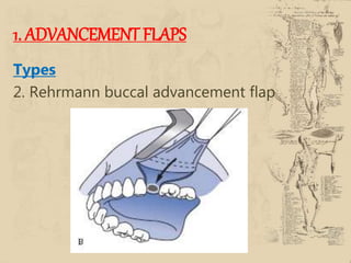 Local and regional flaps in head and neck reconstruction | PPTX