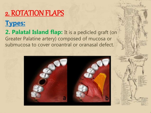 Local and regional flaps in head and neck reconstruction | PPTX | Death ...