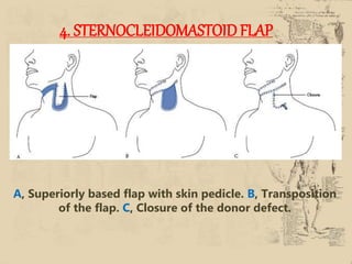 Local and regional flaps in head and neck reconstruction | PPTX