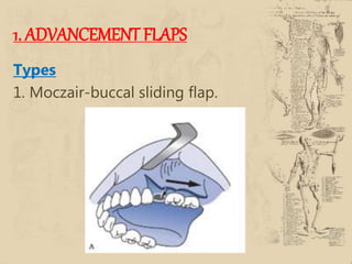 Local and regional flaps in head and neck reconstruction | PPT