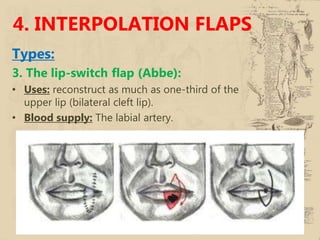 Interpolation Flap