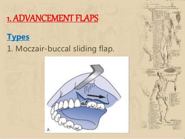 Local And Regional Flaps In Head And Neck Reconstruction