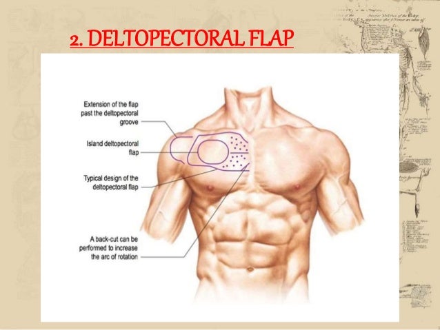 Local And Regional Flaps In Head And Neck Reconstruction
