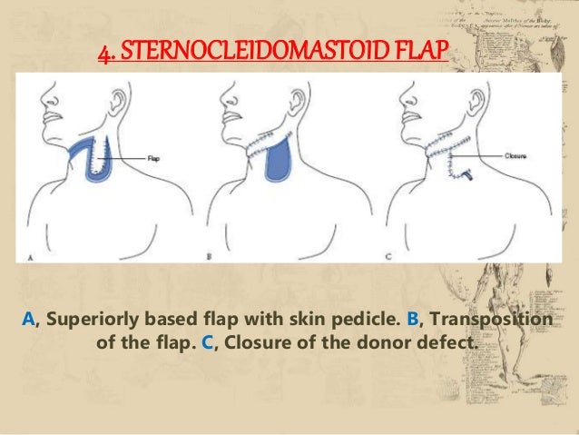 Local and regional flaps in head and neck reconstruction