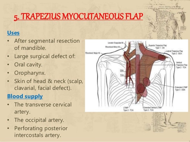 Local and regional flaps in head and neck reconstruction