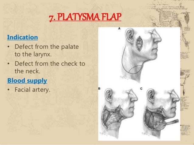 Local and regional flaps in head and neck reconstruction