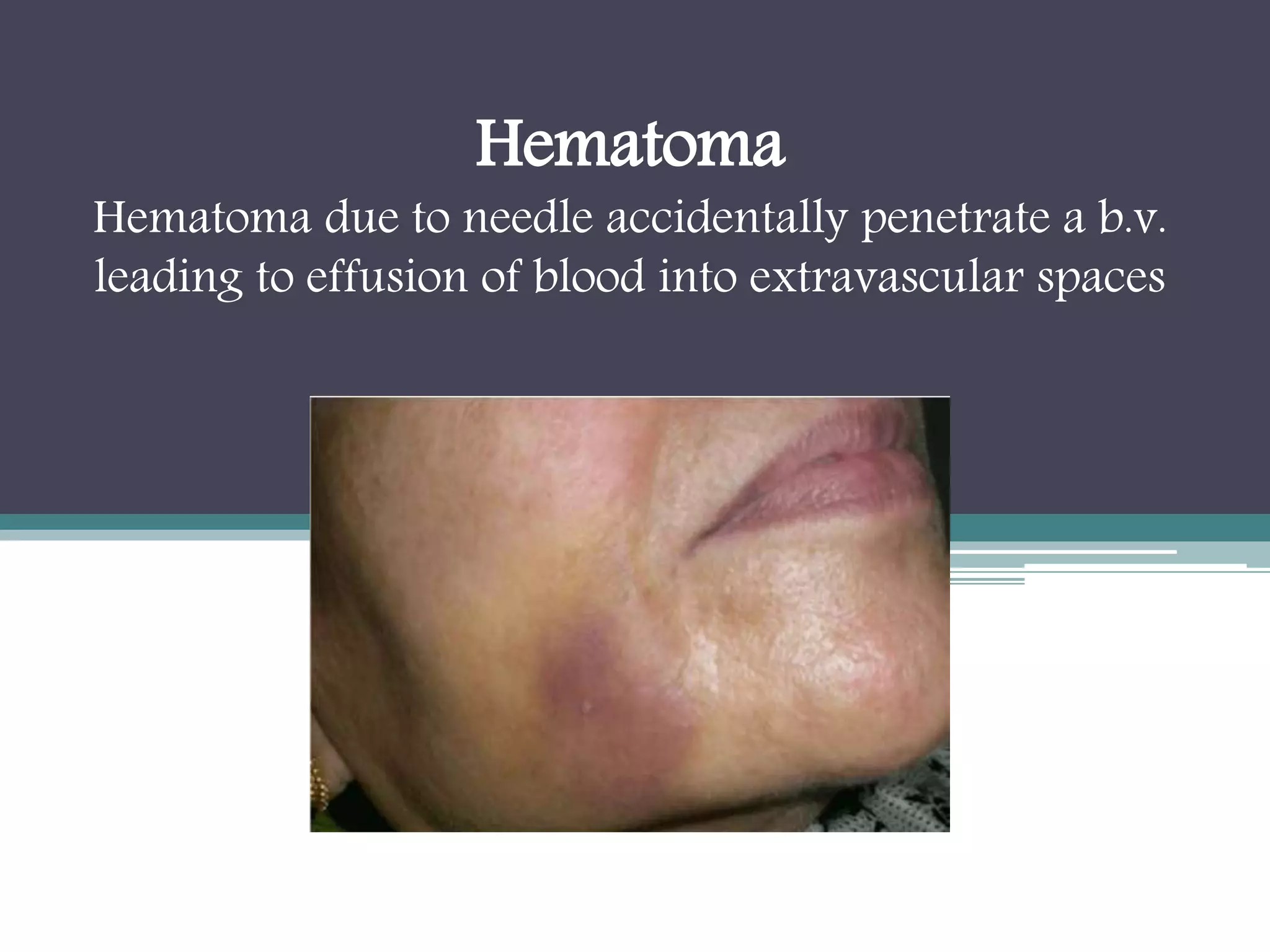 Local and systemic complications of local anesthesia | PPTX