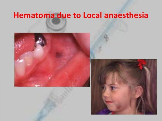 Local anesthesia