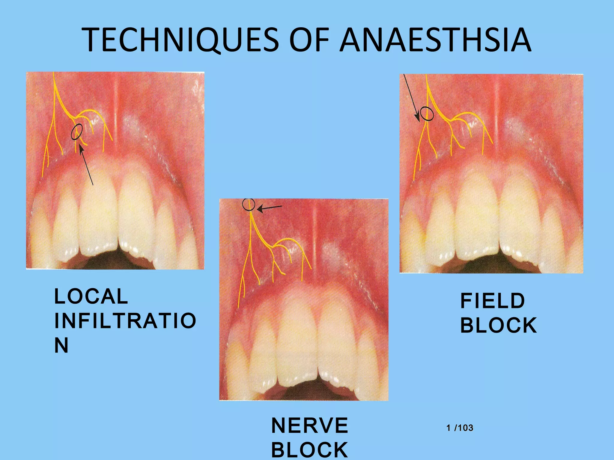 Local anesthesia | PPT