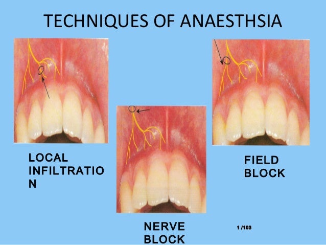 Local anesthesia