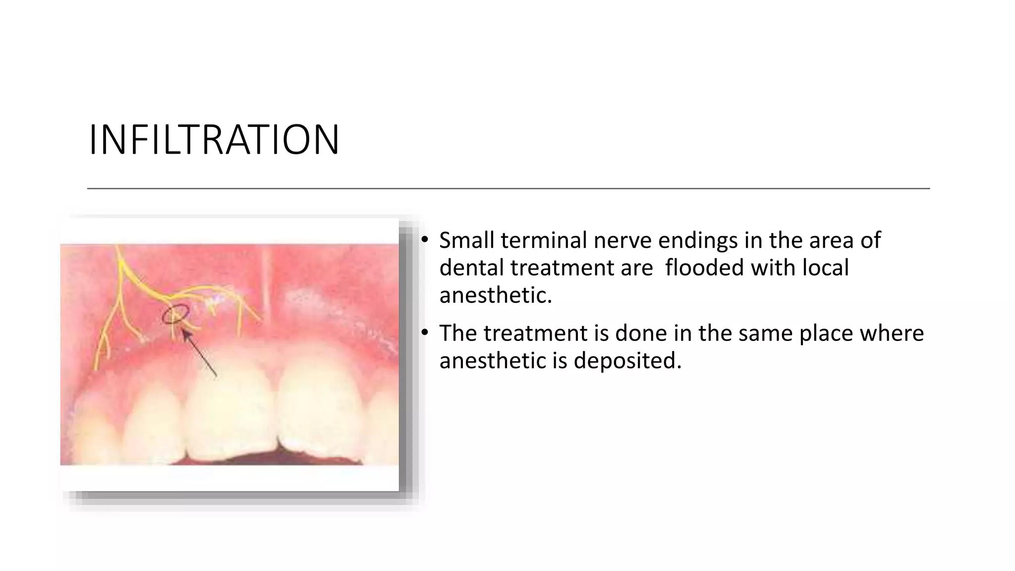 Local anesthesia in dentistry : RECENT ADVANCES | PPTX