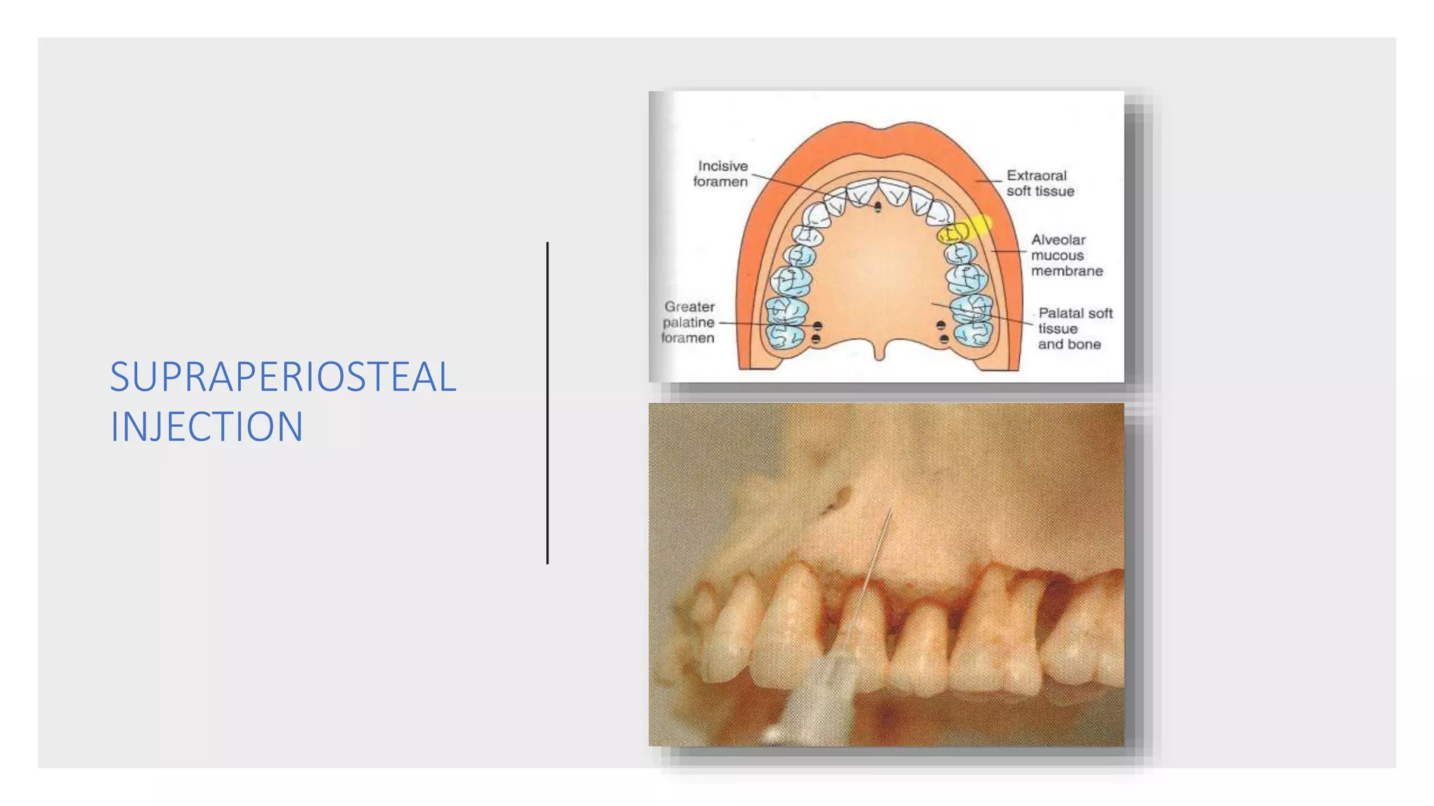 Local anesthesia in dentistry : RECENT ADVANCES | PPTX