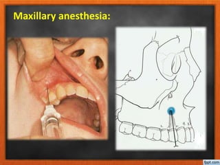Local anesthesia | PPTX