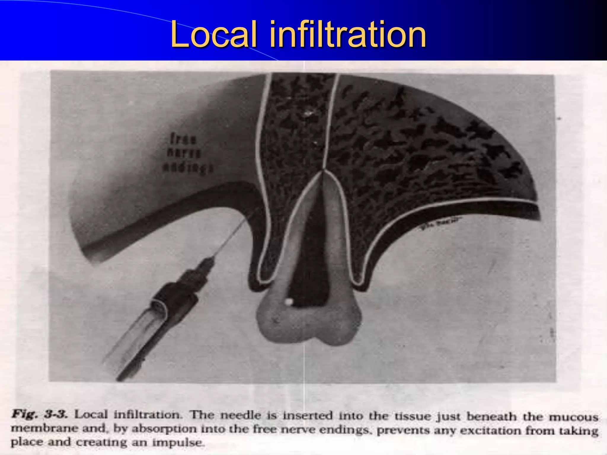 Local anesthesia | PPT