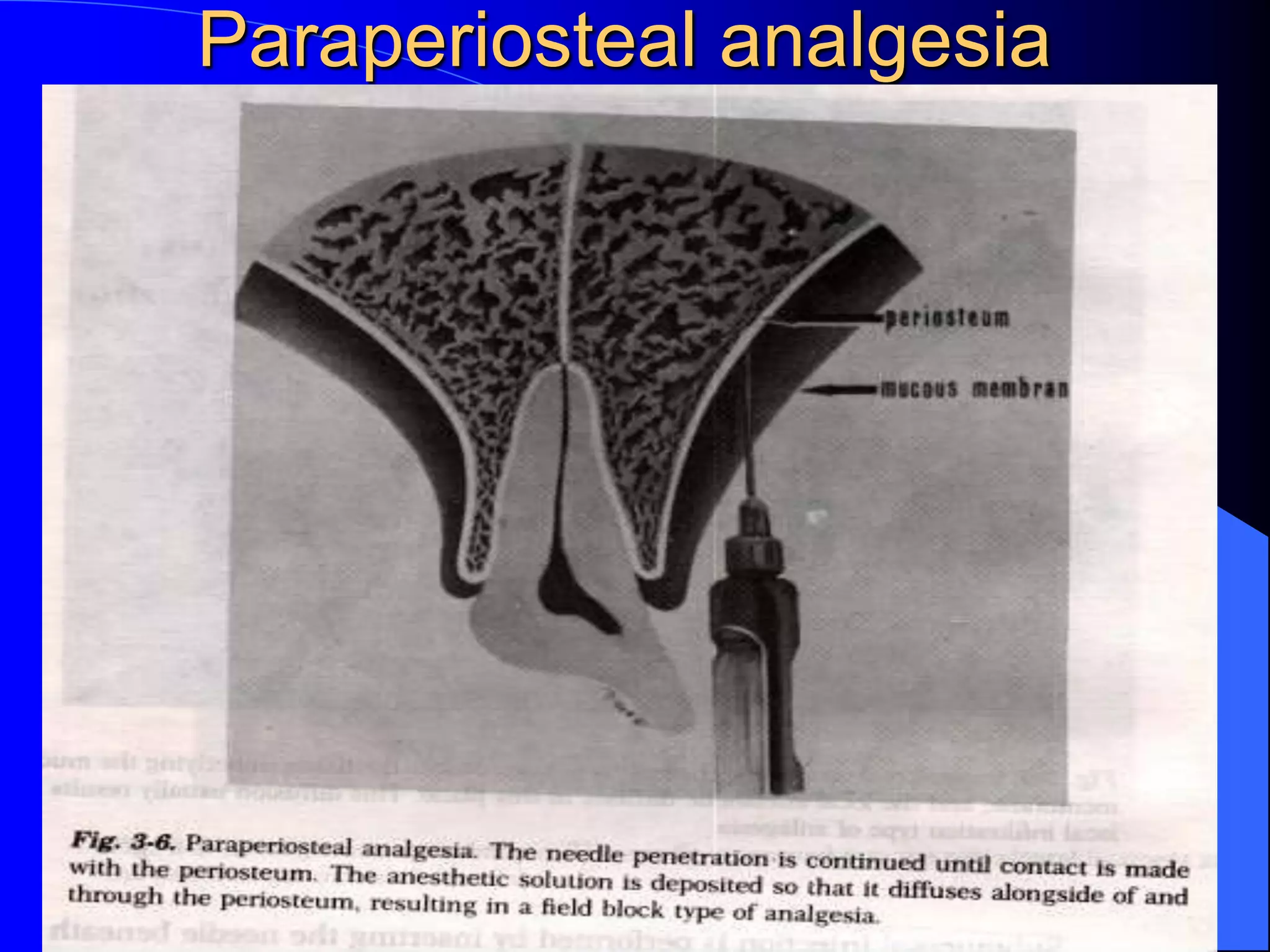 Local anesthesia | PPT | Dental Health | Diseases and Conditions