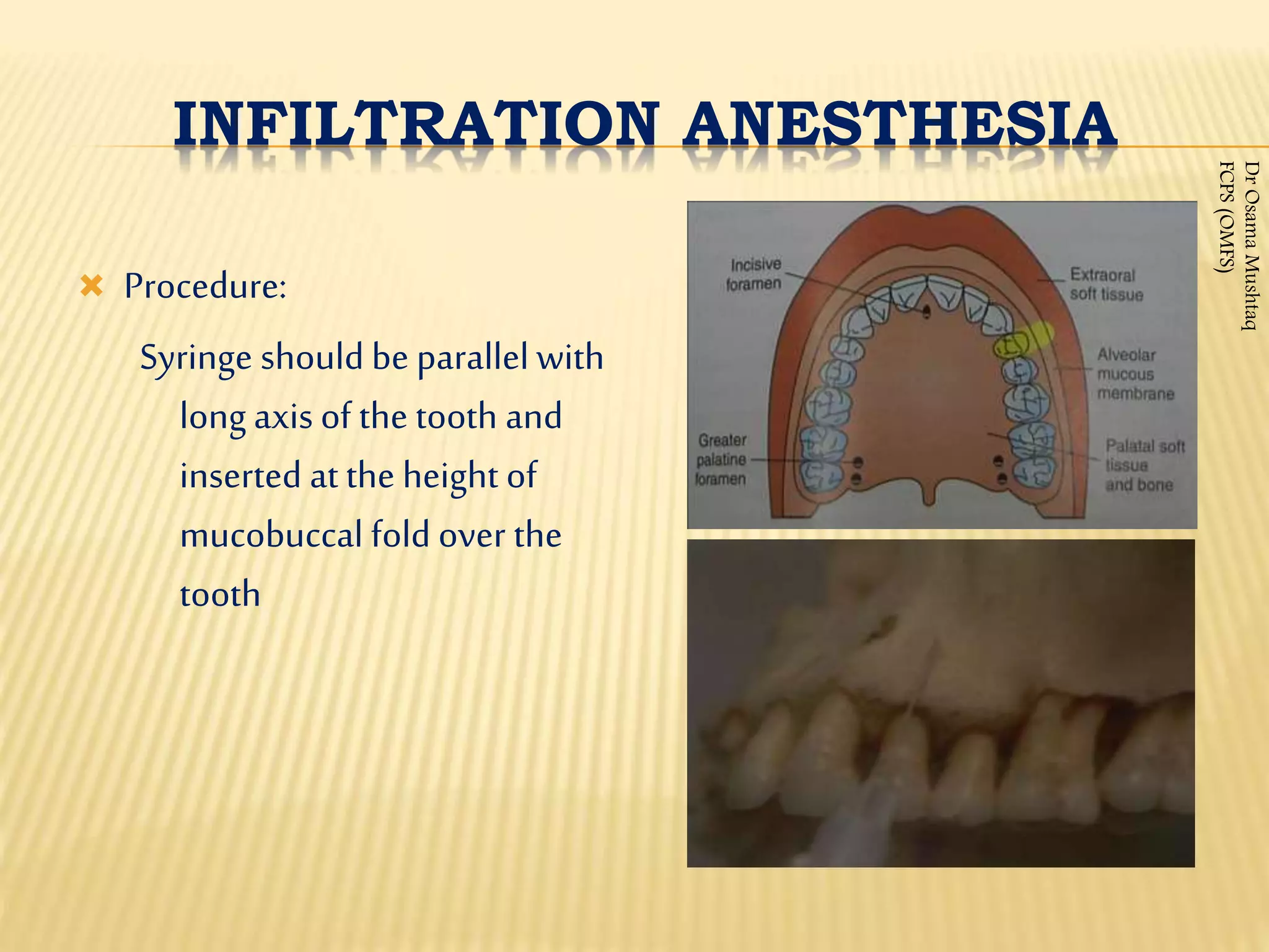 Local Anesthesia for Dental students | PPTX