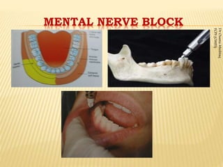 Local Anesthesia for Dental students | PPTX