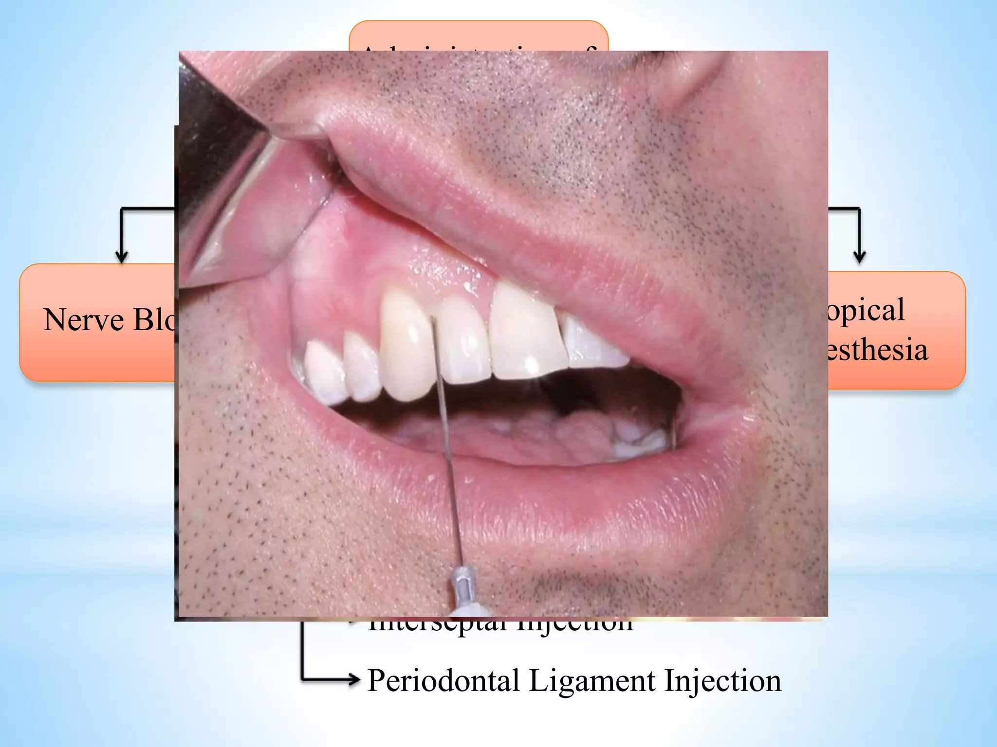 LOCAL ANESTHESIA.pptx