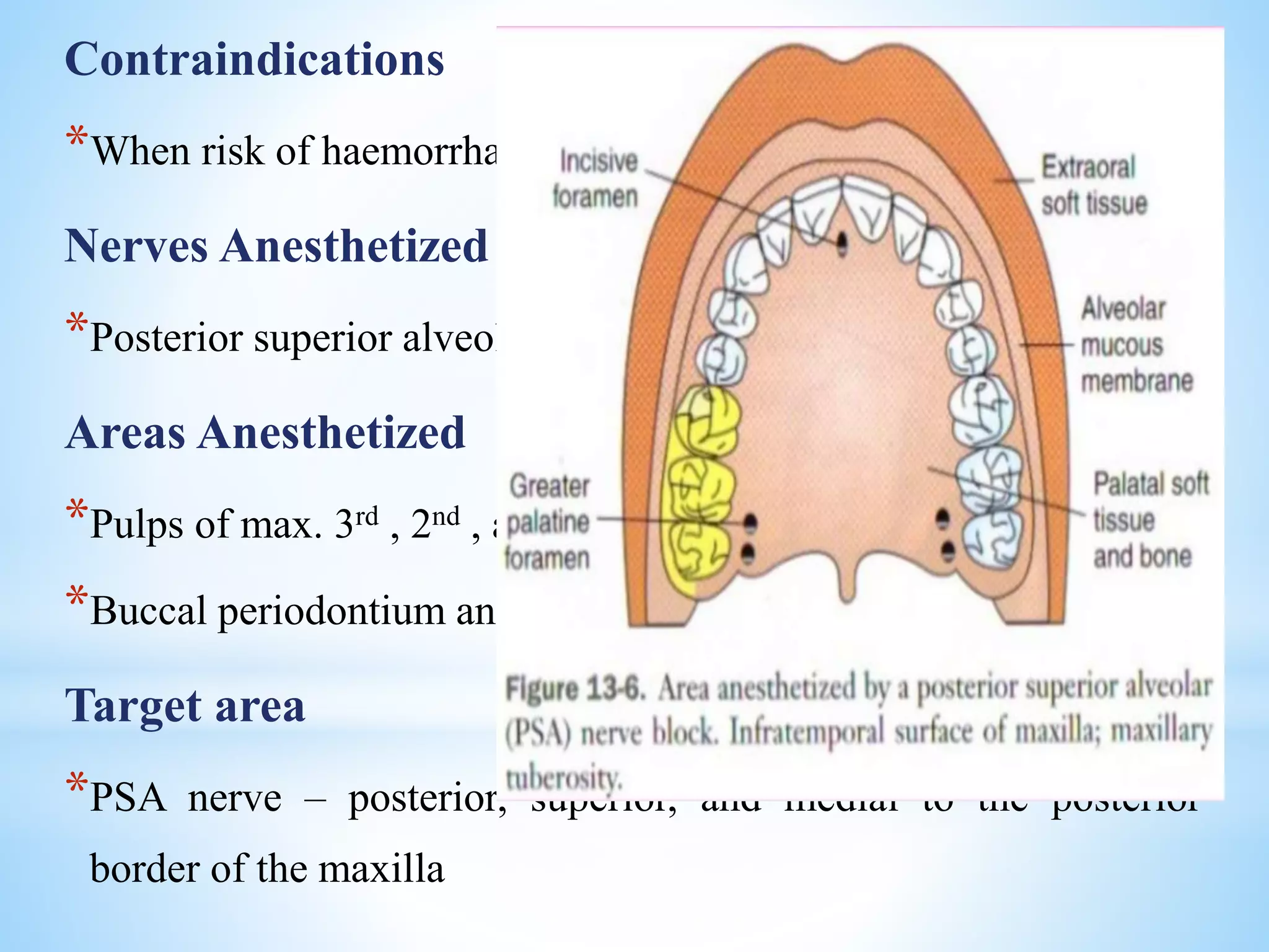 LOCAL ANESTHESIA.pptx