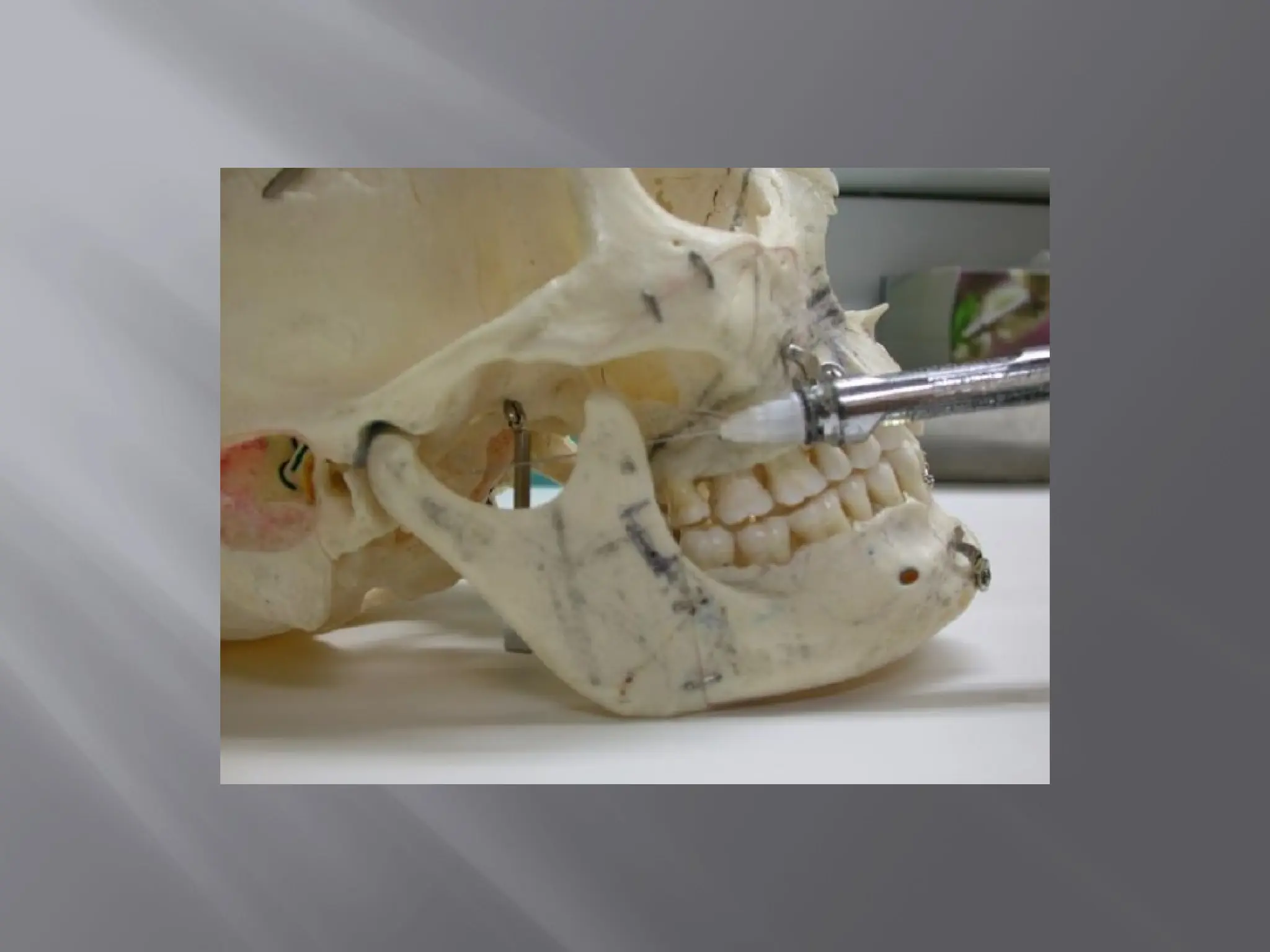LOCAL ANESTHESIA ITS TYPES/ CLASSIFICATION/ MECHANISM OF ACTION USES ...