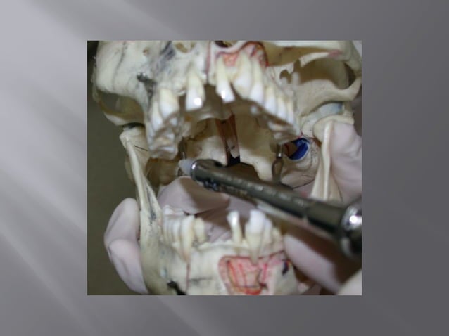 LOCAL ANESTHESIA ITS TYPES/ CLASSIFICATION/ MECHANISM OF ACTION USES ...