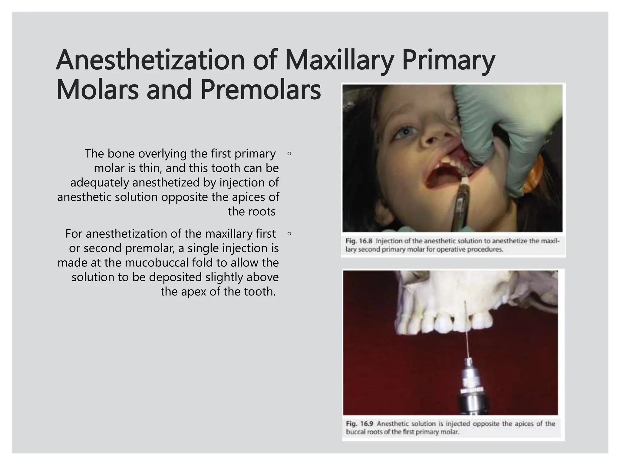 Local Anesthesia in childs [Autosaved].pptx