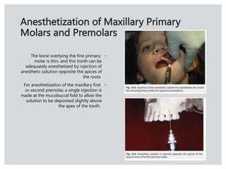 Local Anesthesia in childs [Autosaved].pptx