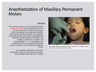Local Anesthesia in childs [Autosaved].pptx