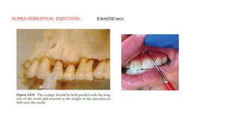 Local anesthesia in dentistry | PPTX