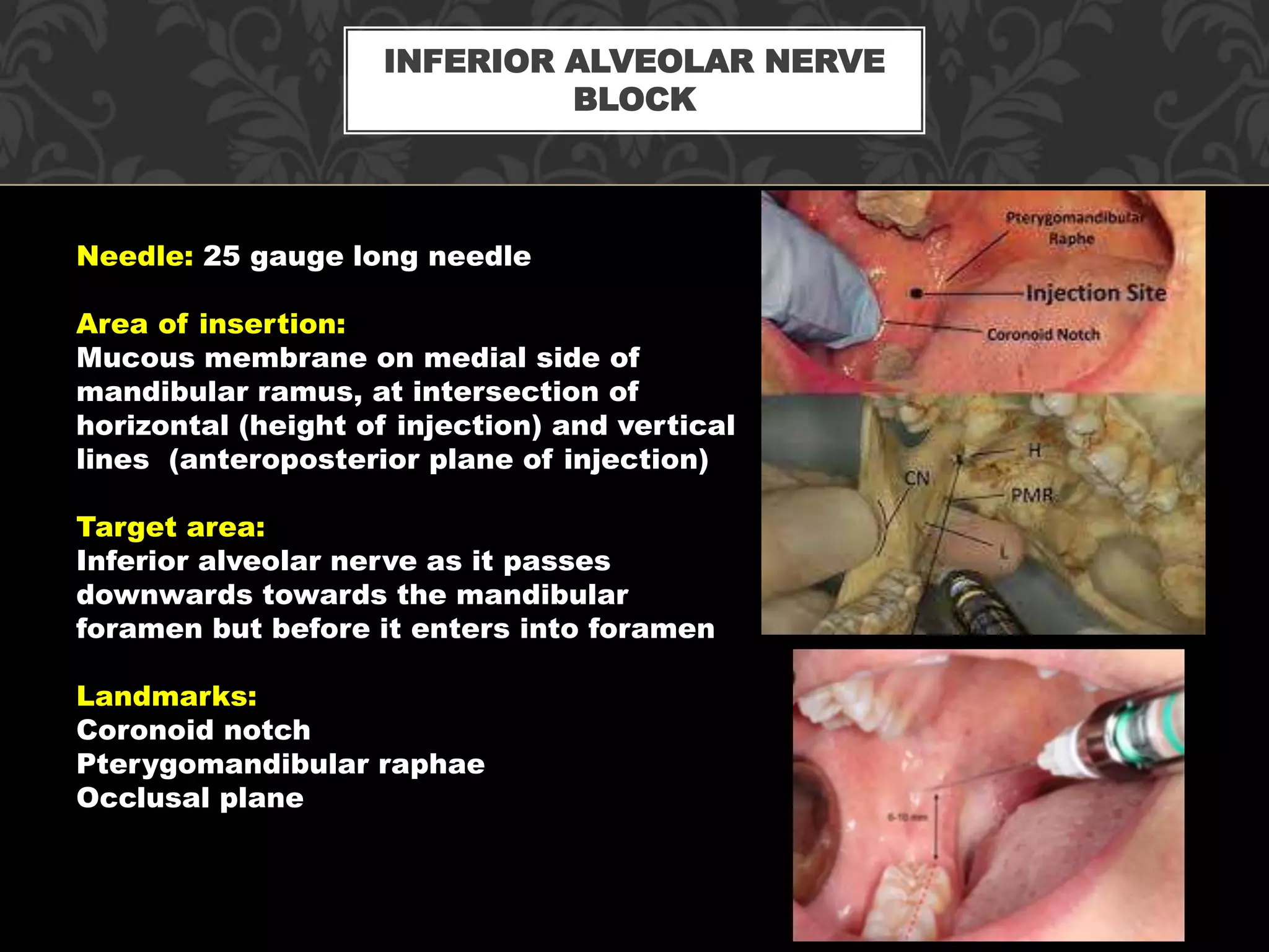 Local anesthesia IN PERIODONTICS DR.ANIZ.pptx