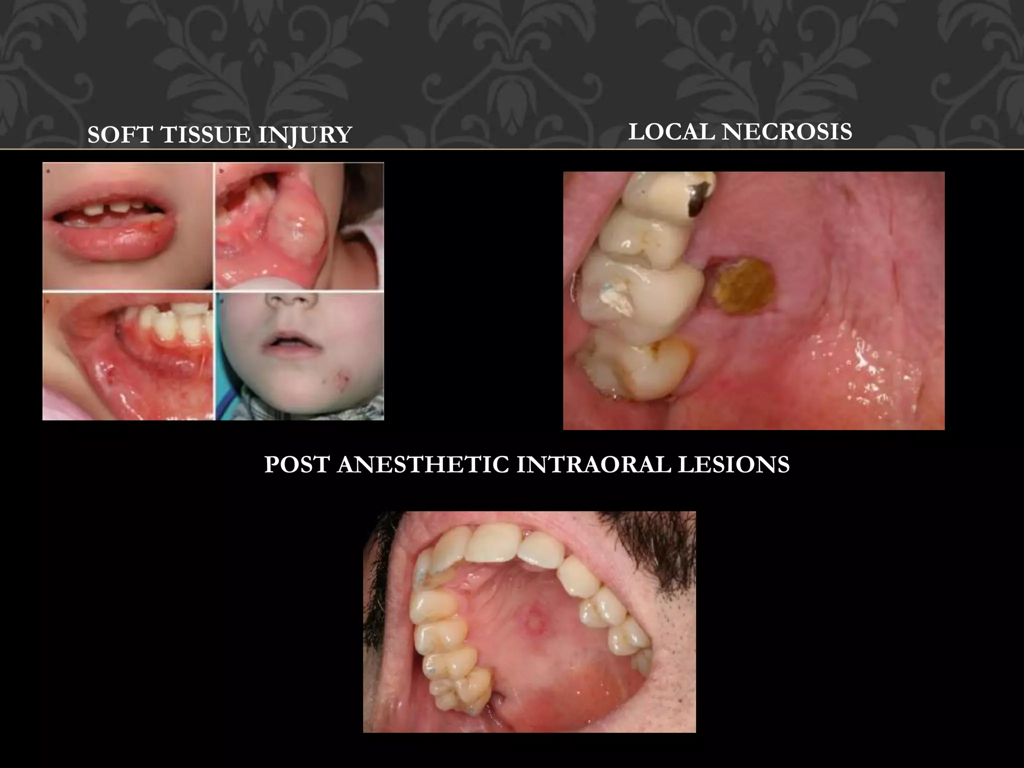 Local anesthesia IN PERIODONTICS DR.ANIZ.pptx
