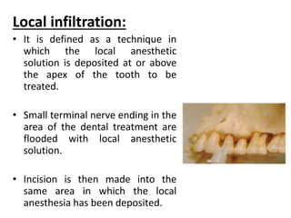 Local anesthesia ppt | PPTX