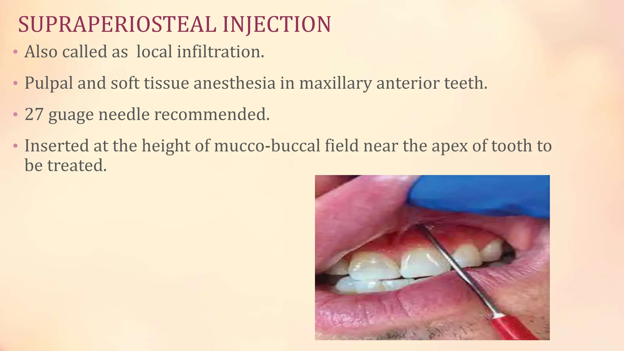 LOCAL ANESTHESIA TECHNIQUE.pptx