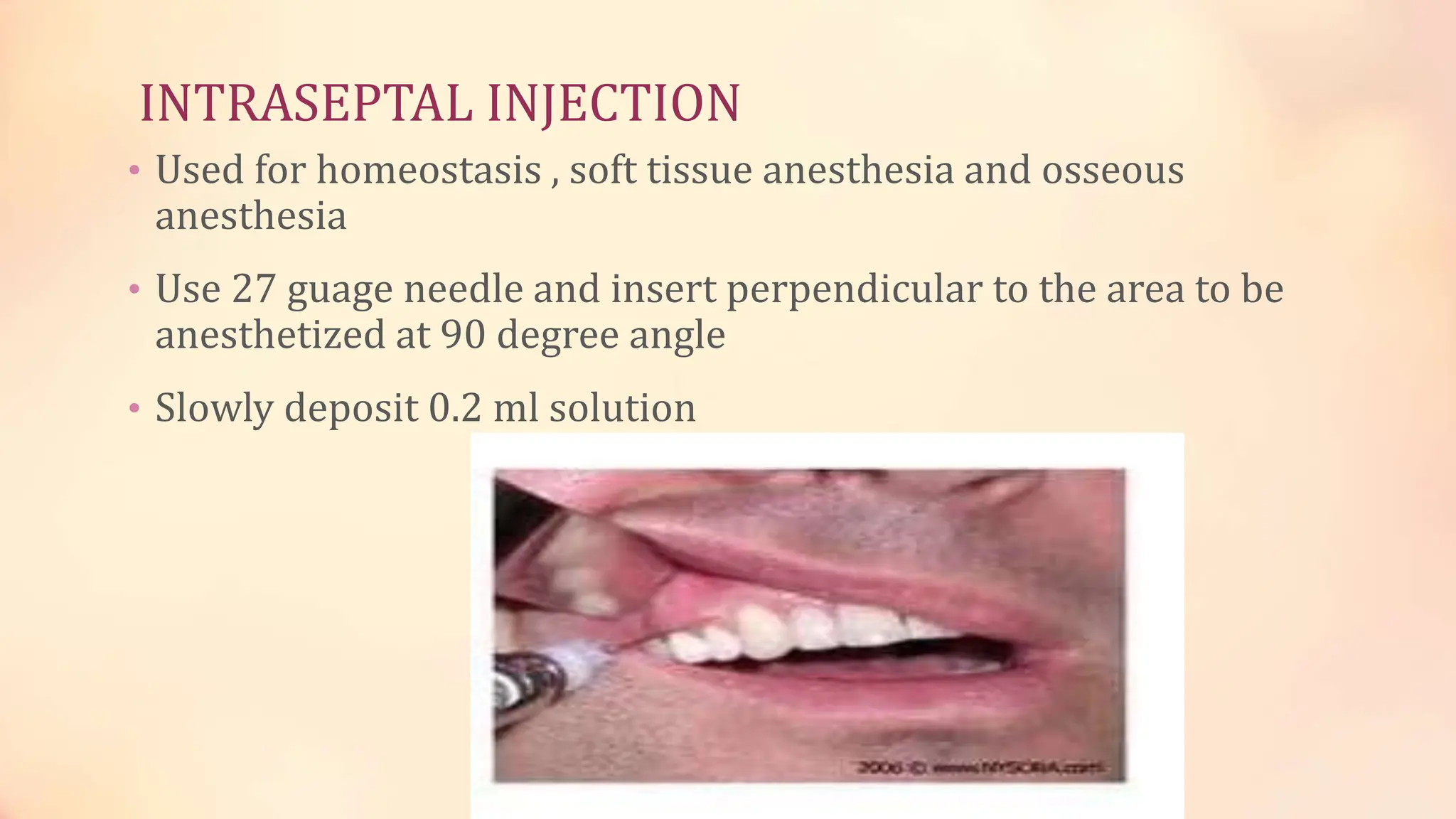 LOCAL ANESTHESIA TECHNIQUE.pptx