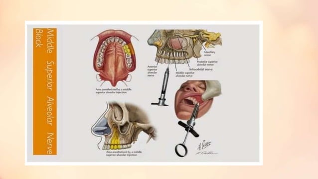 LOCAL ANESTHESIA TECHNIQUE.pptx | Ear, Nose and Throat Conditions ...