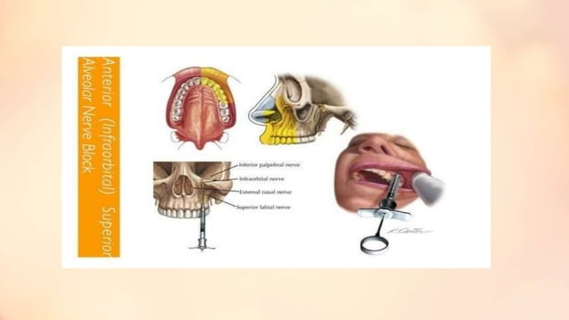 LOCAL ANESTHESIA TECHNIQUE.pptx | Ear, Nose and Throat Conditions ...