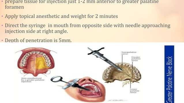 LOCAL ANESTHESIA TECHNIQUE.pptx | Ear, Nose and Throat Conditions ...