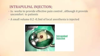 LOCAL ANESTHESIA TECHNIQUE.pptx