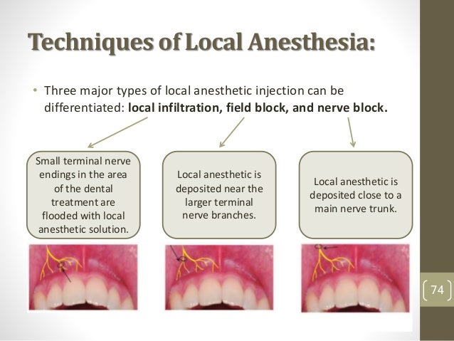 Local anesthetic agents by Dr. Deepesh