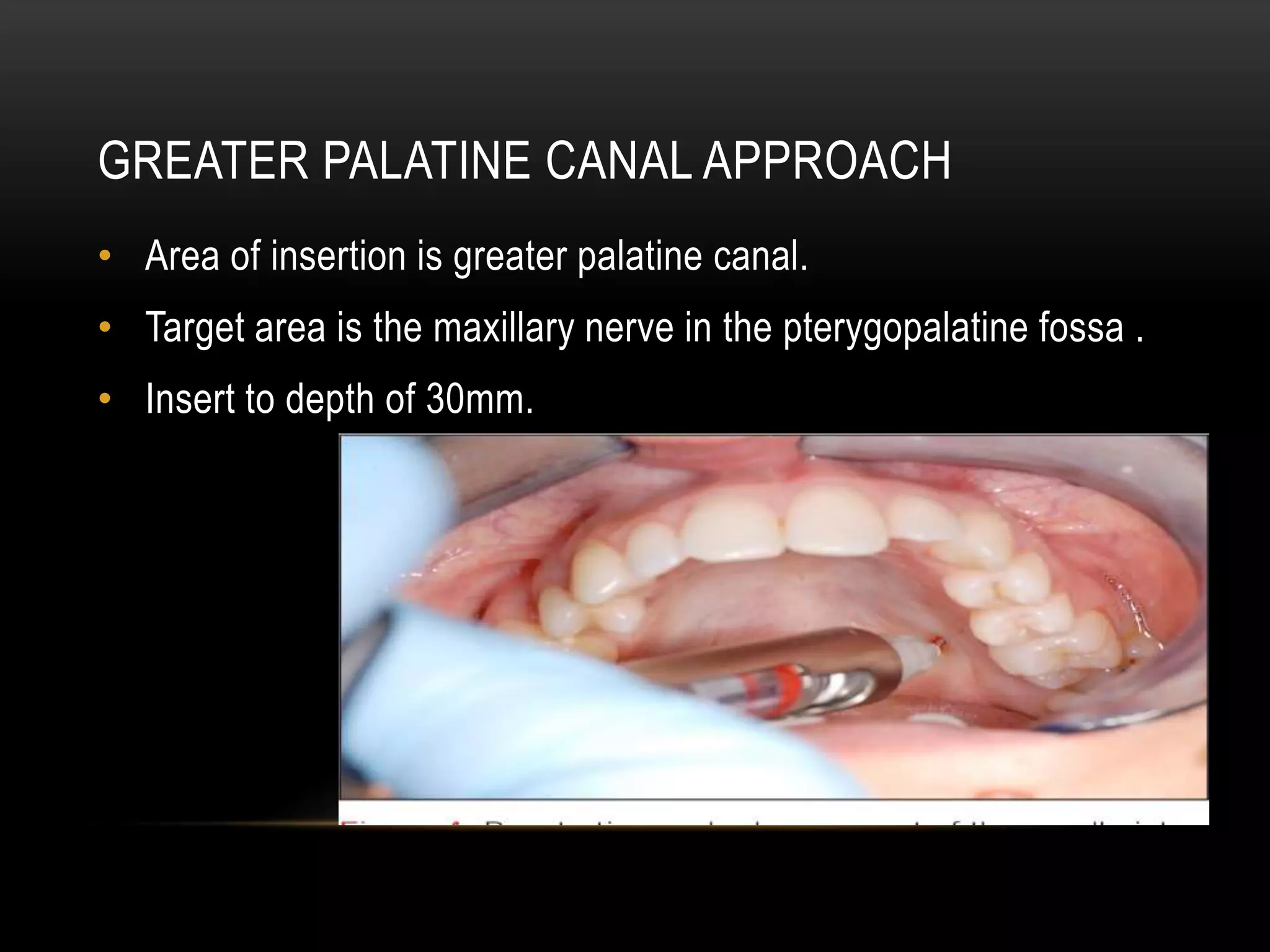 Local anesthetic of maxillary | PPTX