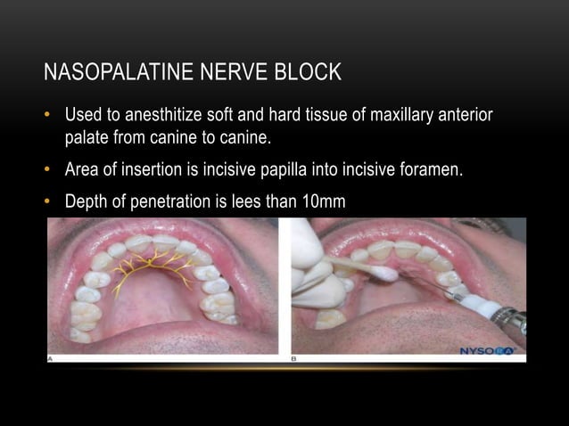 Local anesthetic of maxillary | PPTX | Ear, Nose and Throat Conditions ...