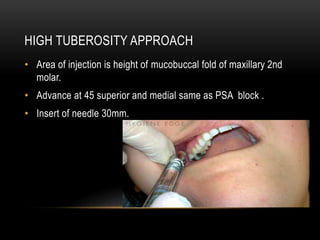 Local anesthetic of maxillary | PPTX