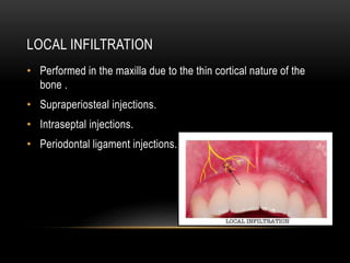 Local anesthetic of maxillary | PPTX