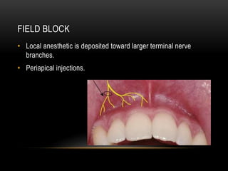 Local anesthetic of maxillary | PPTX