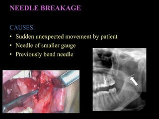 Local anesthetic complications | PPTX