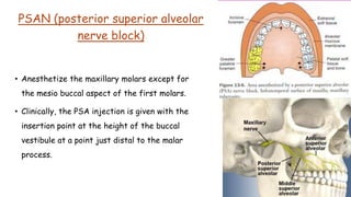 Local anesthetic techniques | PPTX