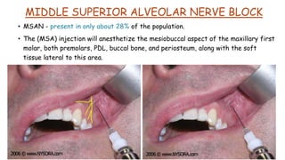 Local anesthetic techniques | PPTX