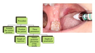 Local anesthetic techniques | PPTX