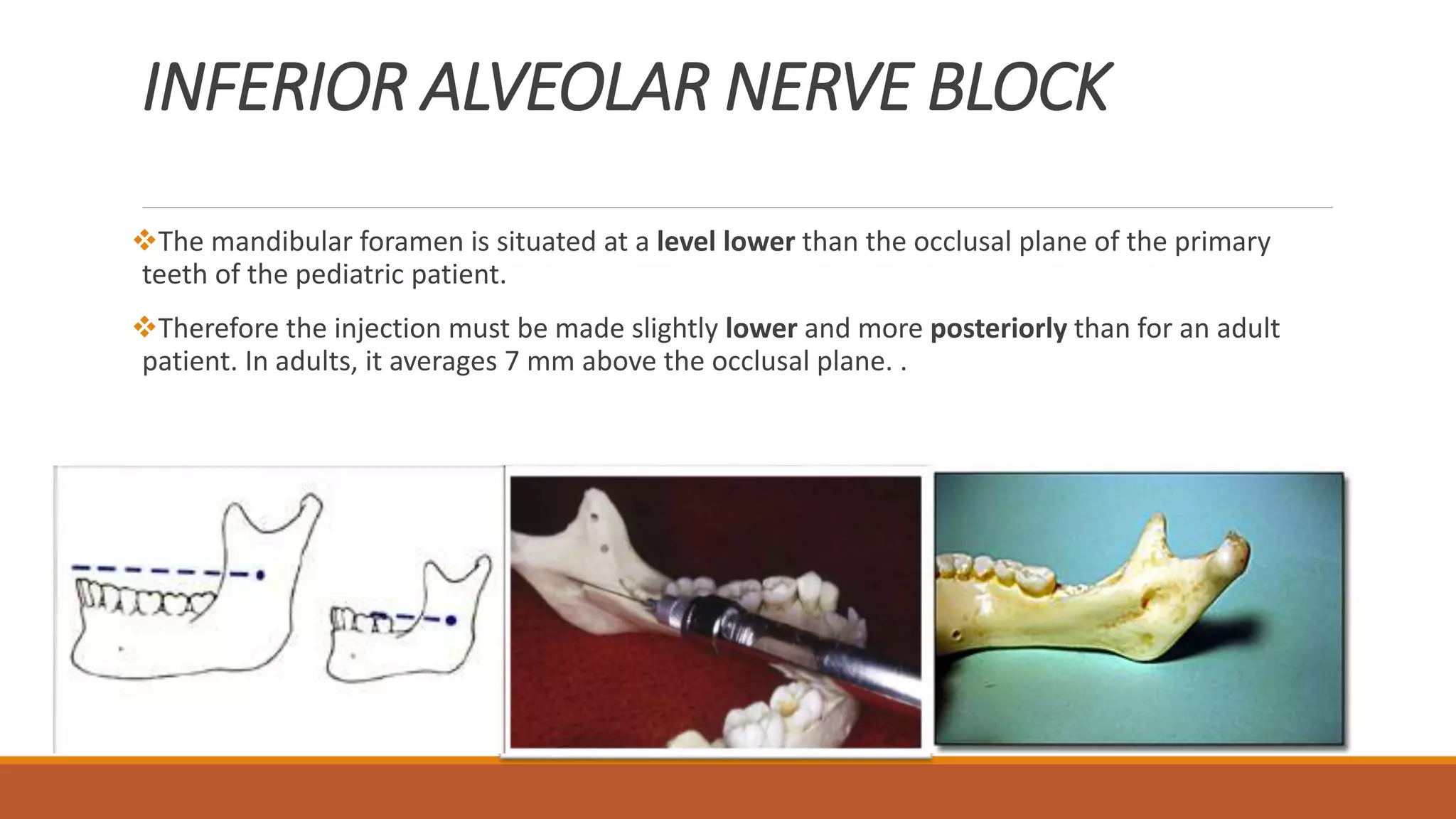 MANDIBULAR NERVE BLOCK in pediatric | PPTX